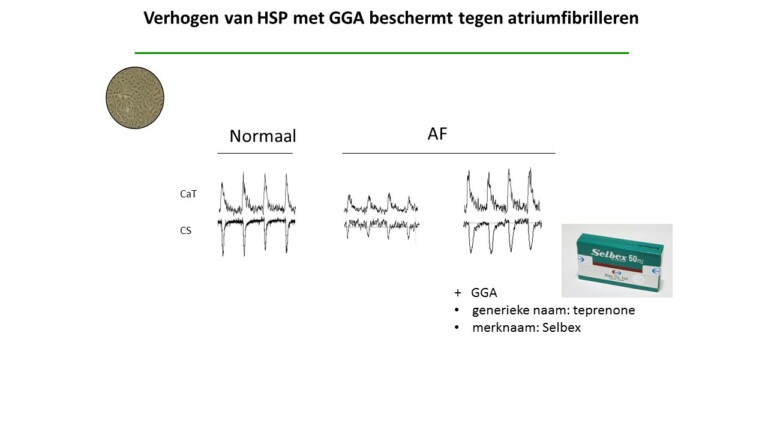 Atriumfibrilleren: Dé hartritmestoornis van de 21e eeuw – Stichting AFIP