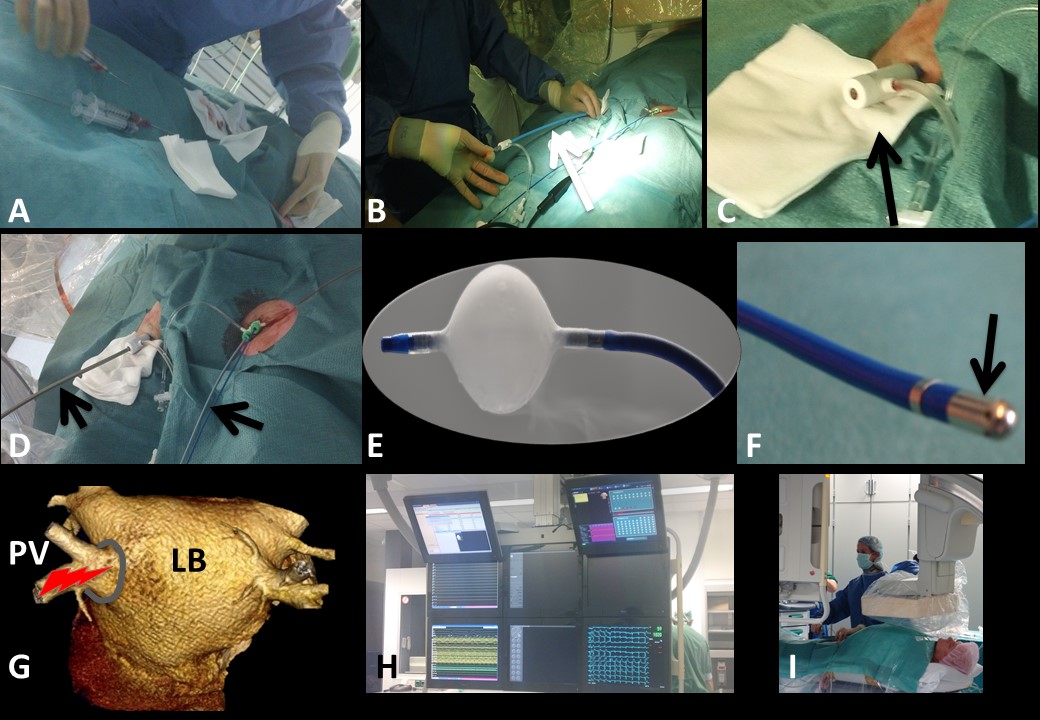 Atriumfibrilleren: Dé hartritmestoornis van de 21e eeuw – Stichting AFIP