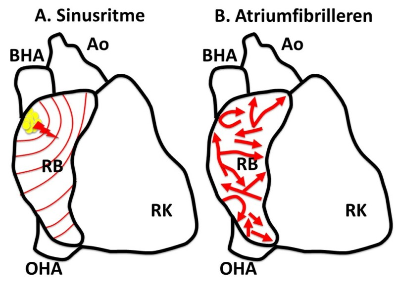 Atriumfibrilleren: Dé hartritmestoornis van de 21e eeuw – Stichting AFIP