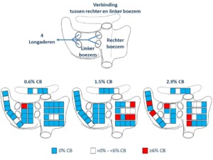 Boezemfibrilleren behandelen met ablatie - Stichting AFIP